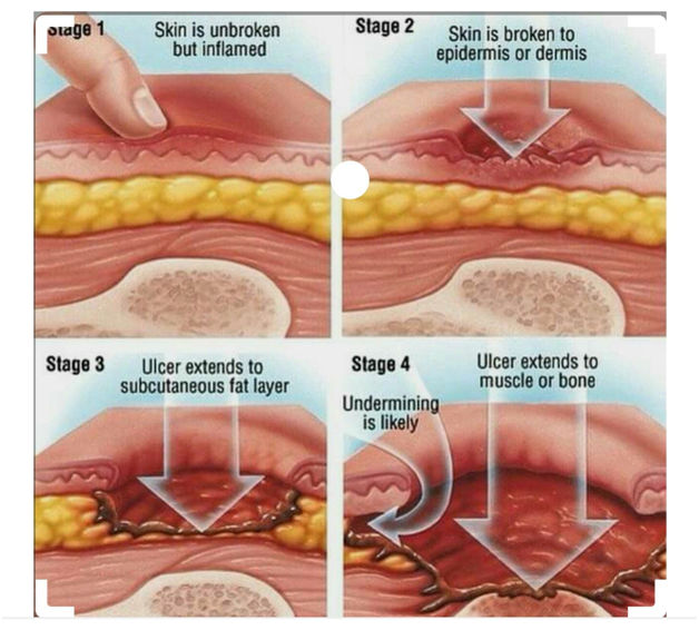 PRESSURE ULCER MANAGEMENT - Triage Meditech | Tealfeed