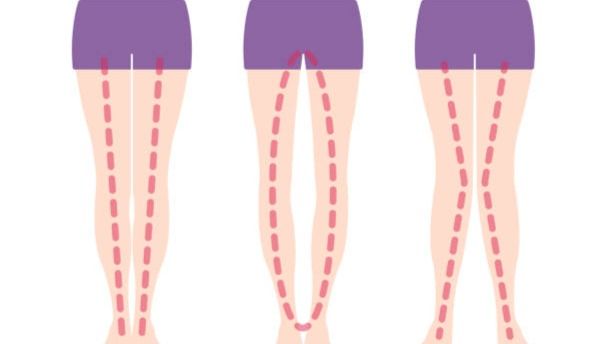 How To Fix Your Genu valgum Through Exercise - William josephbeth ...