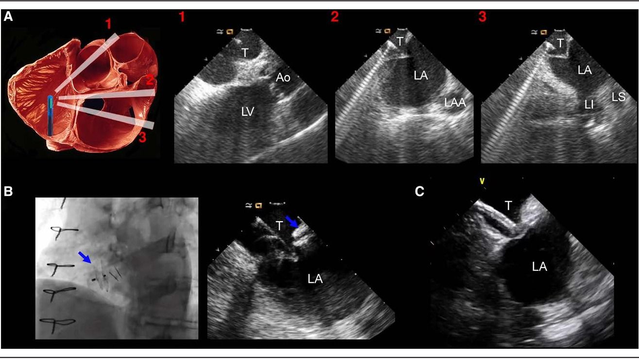 Future Trends of Intracardiac Echocardiography (PDF Guide) - kartik ...