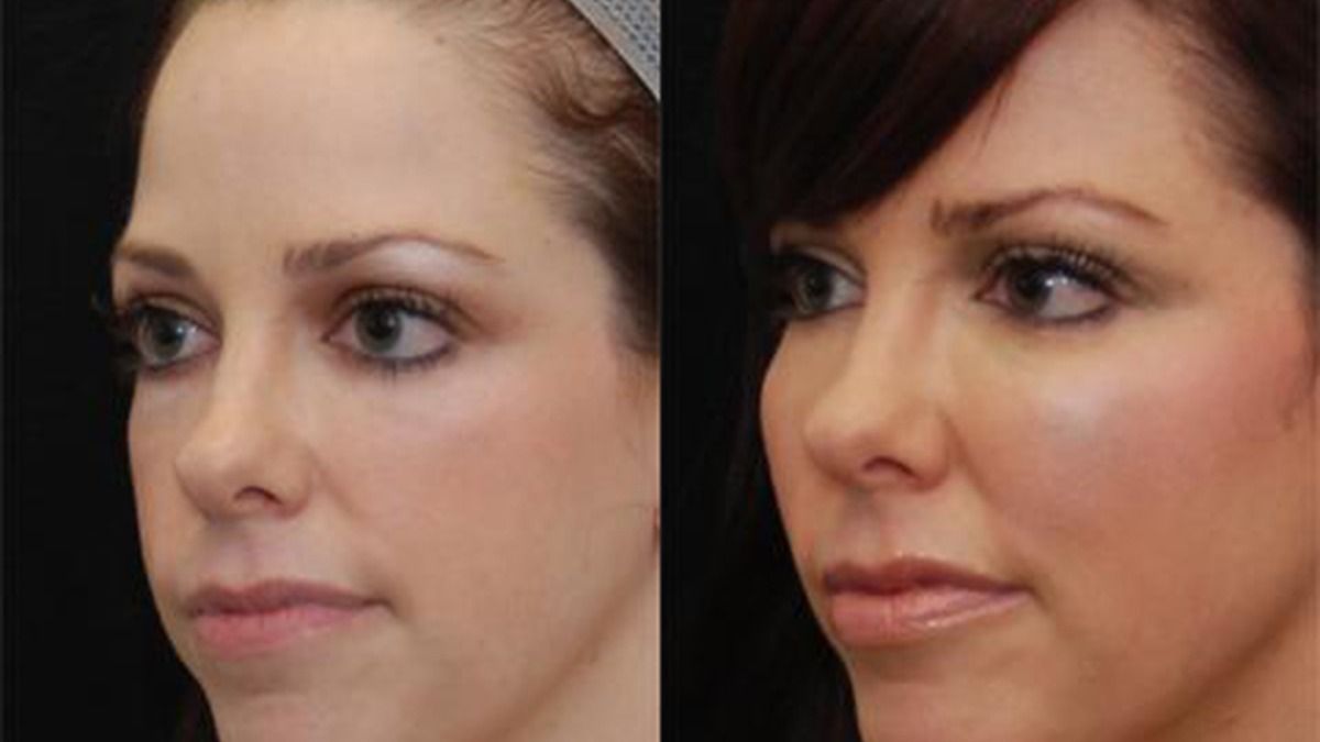 How Long Does Forehead Fat Graft Last? - JohnVick | Tealfeed